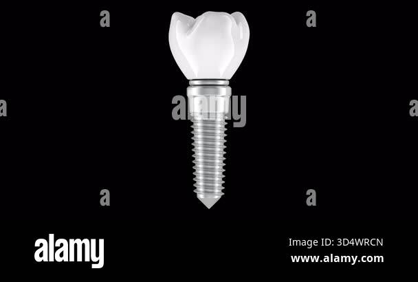 Dental implant rotation animation, seamlessly loopable. 3D rendering ...