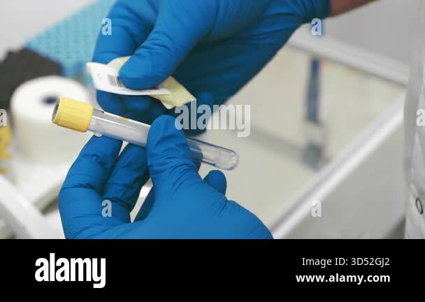Close up of lab worker in blue gloves attaching barcode label on blood ...