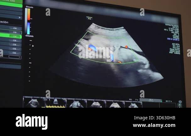 Close-up of ultrasound monitor displaying baby during pregnancy exam ...