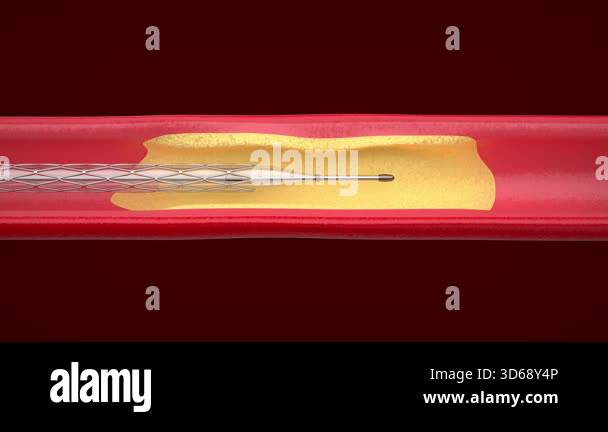 Balloon angioplasty procedure with stent placement inside blood vessel ...