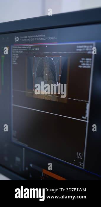Kyiv, Ukraine, 2 August 2025: CT monitor displaying a low-dose X-ray ...