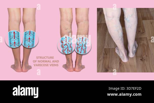 Varicose veins on a female senior legs. The structure of normal and ...