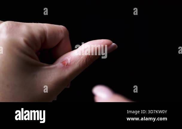 Female Palm with Skin Burn or Wound, Black Background. Healing wound on ...
