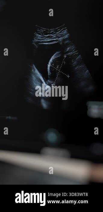 Close up of an ultrasound fetal scan displayed on a medical monitor ...