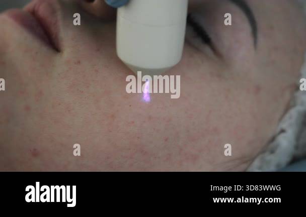 Close up of plasma skin treatment on cheek during aesthetic dermatology ...