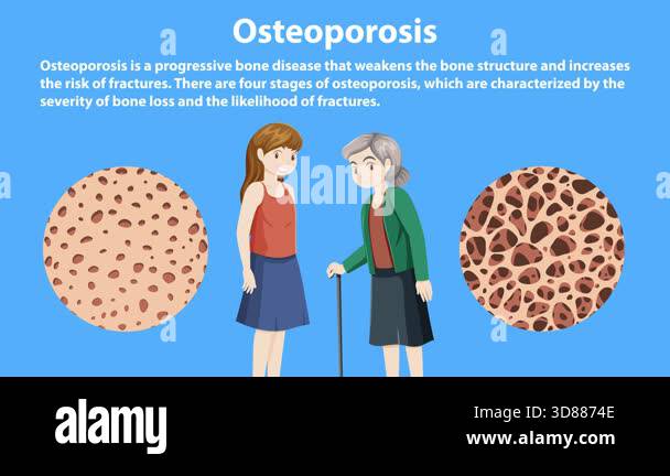 Stages of bone density loss in osteoporosis Stock Video Footage - Alamy