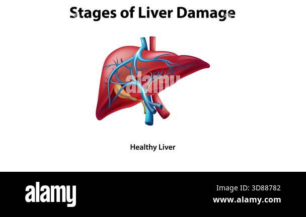 Stages liver damage disease Stock Videos & Footage - HD and 4K Video ...