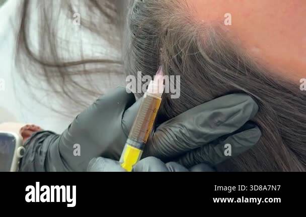 Close-up of a cosmetic procedure: trichology specialist performs scalp ...