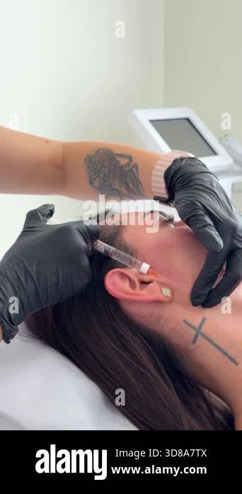 Aesthetic medicine: Close-up of collagen biorevitalization treatment ...