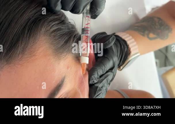 Aesthetic medicine: Close-up of collagen biorevitalization treatment ...
