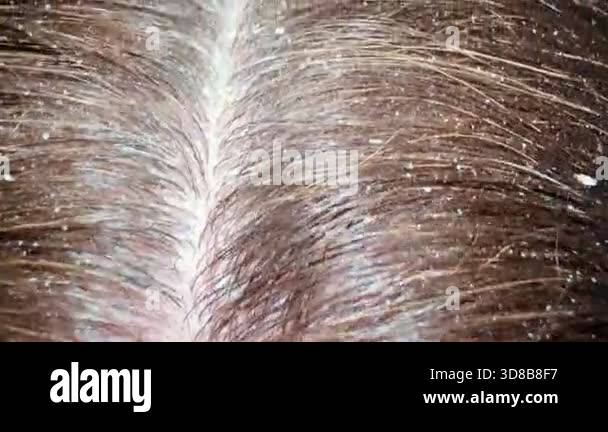 A close-up of dirty, unkempt hair with dandruff and damaged scalp ...