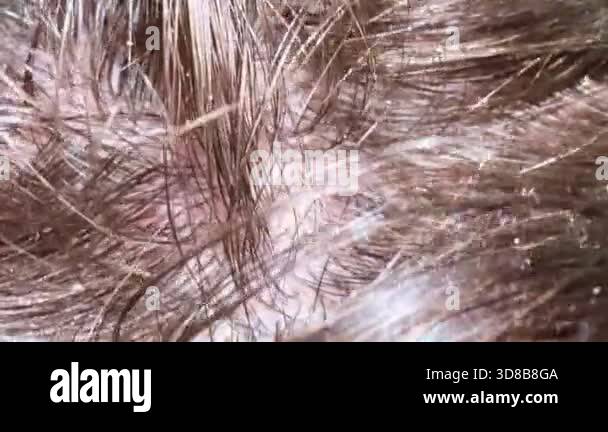 A close-up of dirty, unkempt hair with dandruff and damaged scalp ...