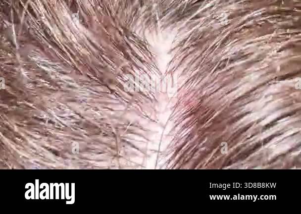 A close-up of dirty, unkempt hair with dandruff and damaged scalp ...