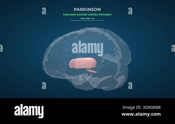 Parkinson-related mental-health disruption shown through altered basal ...