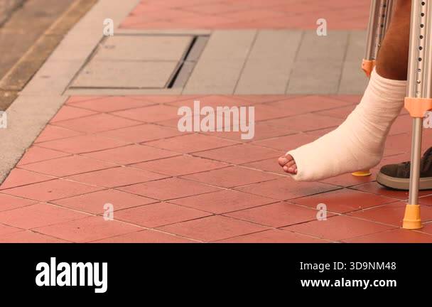 Man with leg cast walking on street using crutch recovery and urban ...