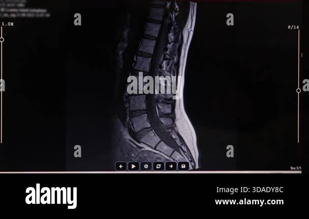 Doctor examines an MRI scan of the lumbar spine, highlighting a mild ...
