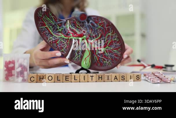 Wooden blocks spell word Cholelithiasis near liver with gallbladder ...