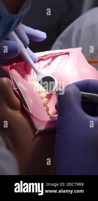 Close-up of dentist shaping composite filling and forming natural ...