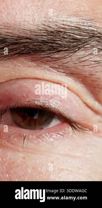 CloseUp Man Eye Showing Irritated Eyelid, Blinking And Closing To ...