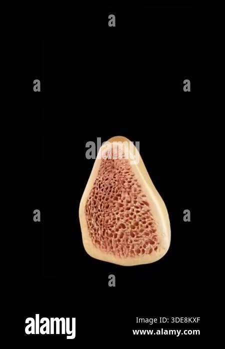 dental implantology bone loss bone graft dental CGI animation Stock ...