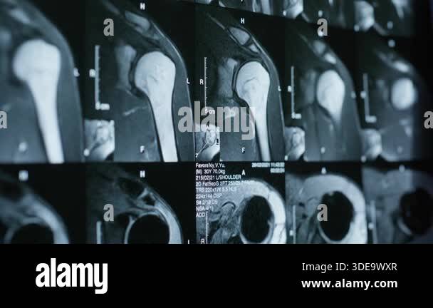 Human bone structure illuminated on medical x-ray monitor closeup ...