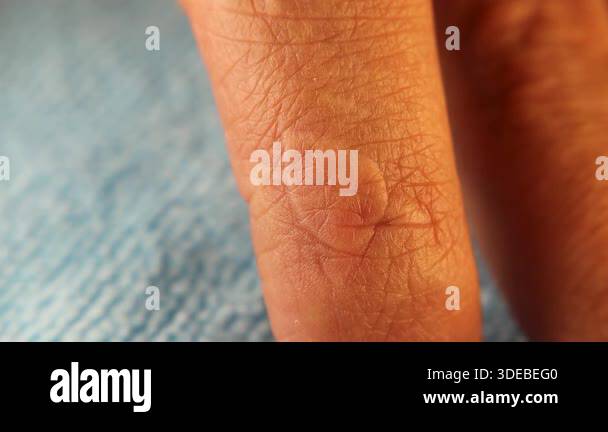 Skin graft hand Stock Videos & Footage - HD and 4K Video Clips - Alamy