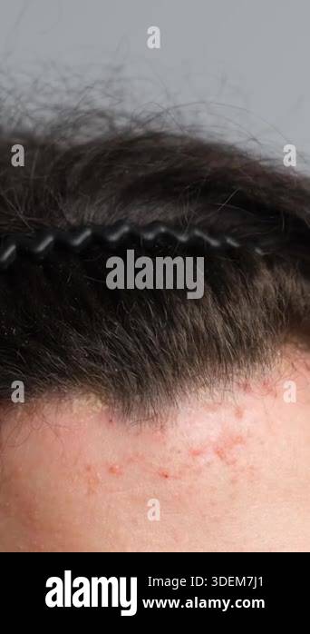 Close-up of a person s forehead with acne and irritation along the ...