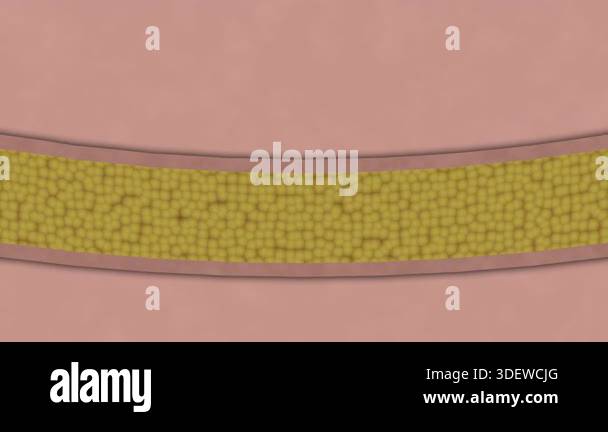 Animation showing a blood vessel clogged with fat and cholesterol ...