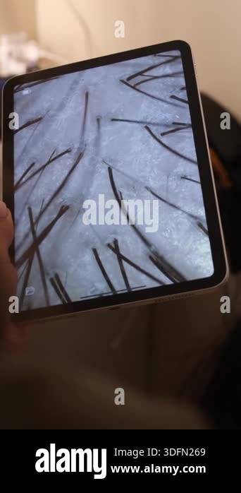 Trichologist performs scalp diagnostics using a trichoscope, showing ...