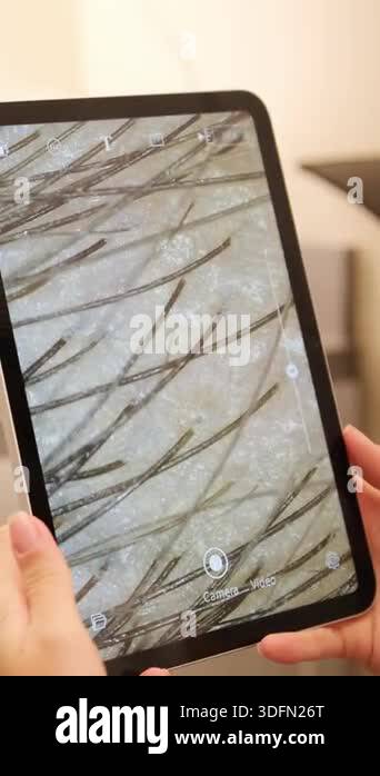 Professional trichologist examining patients hair and scalp using a ...