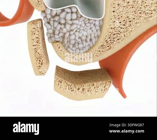 Bone graft Stock Videos & Footage - HD and 4K Video Clips - Alamy
