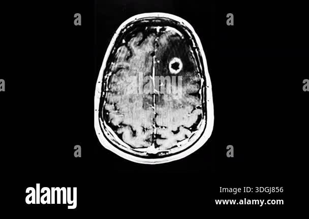 CT brain - left frontal abscess with ventriculitis Stock Video Footage ...