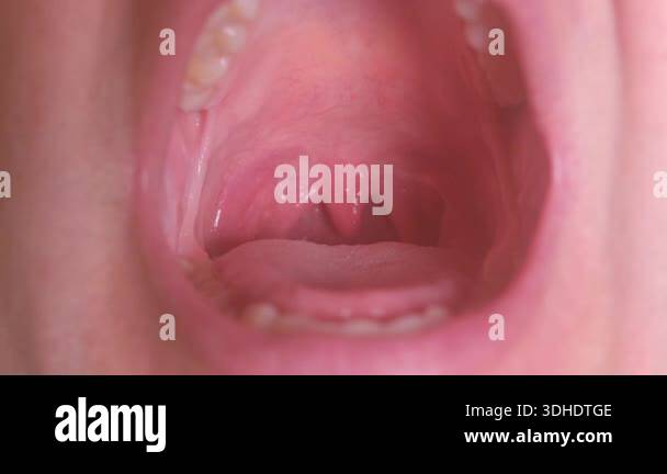 Extreme close-up of a persons open mouth showing red and inflamed ...
