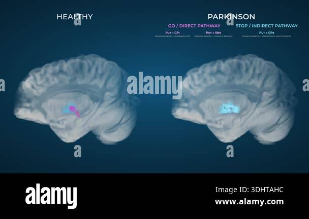Parkinson dopamine loss compared to healthy basal ganglia motor circuit ...