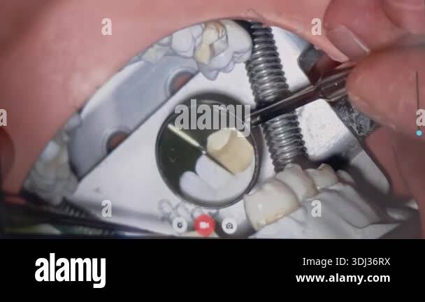 Professional dental procedure with mirror reflecting a tooth in the ...