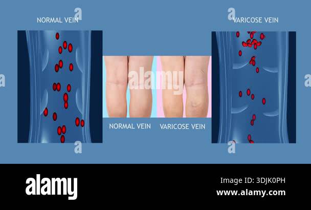 Varicose veins on a female senior legs. The structure of normal and ...