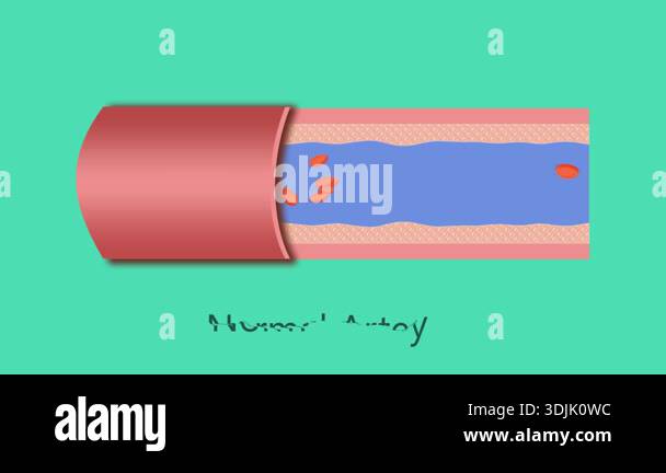 Angioplasty. Stent Implantation. Deflated balloon catheter inserted ...