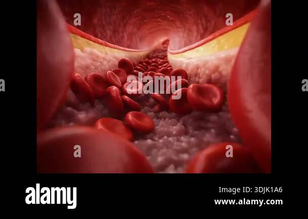 cardiology vein fpp view medical cgi animation atherosclerosis Stock ...