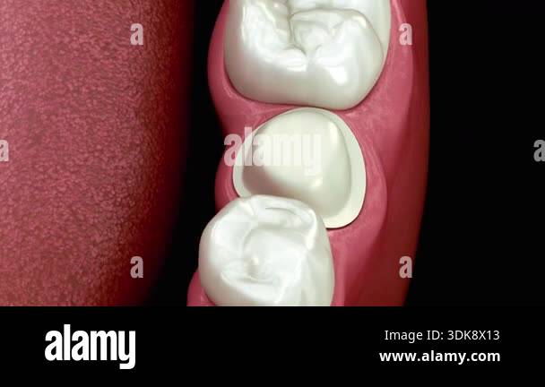 Detailed dental illustration showing a crown on a molar tooth with ...