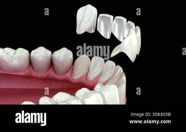 Achieve a perfect smile with dental veneers and teeth alignment. This ...