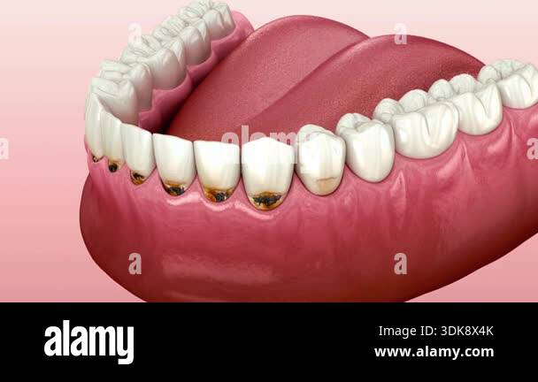Teeth showing early signs of decay and dental health issues Stock Video ...