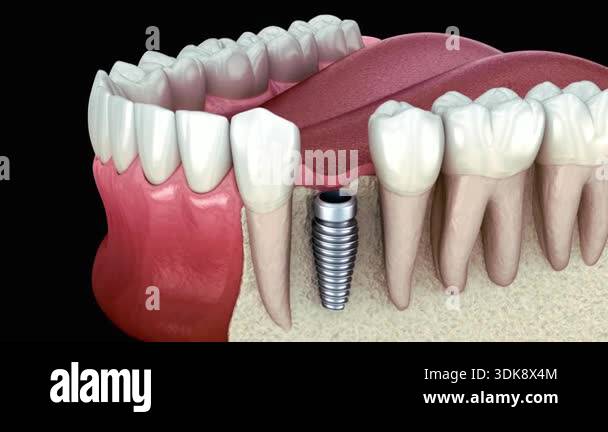 Detailed dental implant model with artificial teeth and gum tissue ...