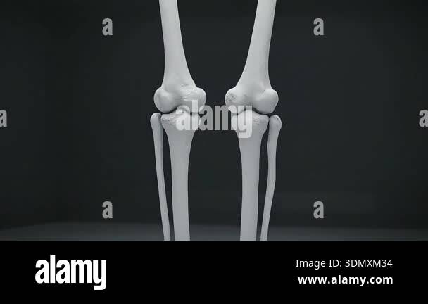 Animated Knee Impact Simulation Showing Bone Fracture Stock Video ...