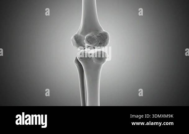 Knee Joint Fracture Animation: Bone Shattering and Breaking Apart in ...