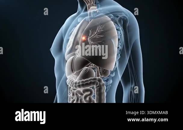 Lung Cancer Progression: 3D Medical Animation of Tumor Growth Stock ...
