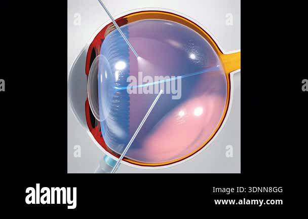 eye surgery procedure medical cgi animation Stock Video Footage - Alamy
