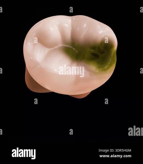 tooth decay carries progress dental 3d cgi animation Stock Video ...
