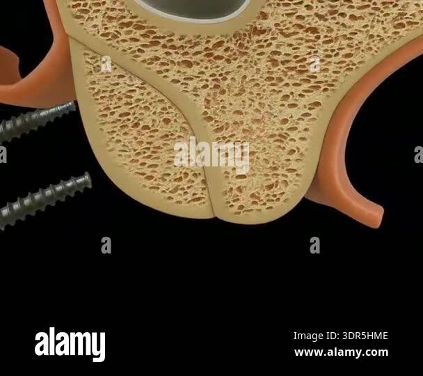 Dental implant surgery bone graft Stock Videos & Footage - HD and 4K ...