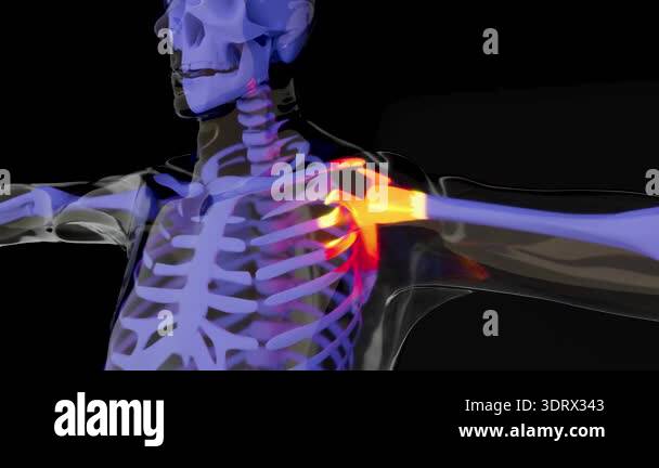 Inflamed Shoulder Muscle Joint Pain Caused by Overuse Injury 3D ...