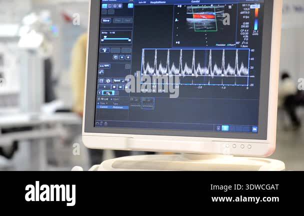 Ultrasound image on the monitor close-up. Ultrasound Scan display ...